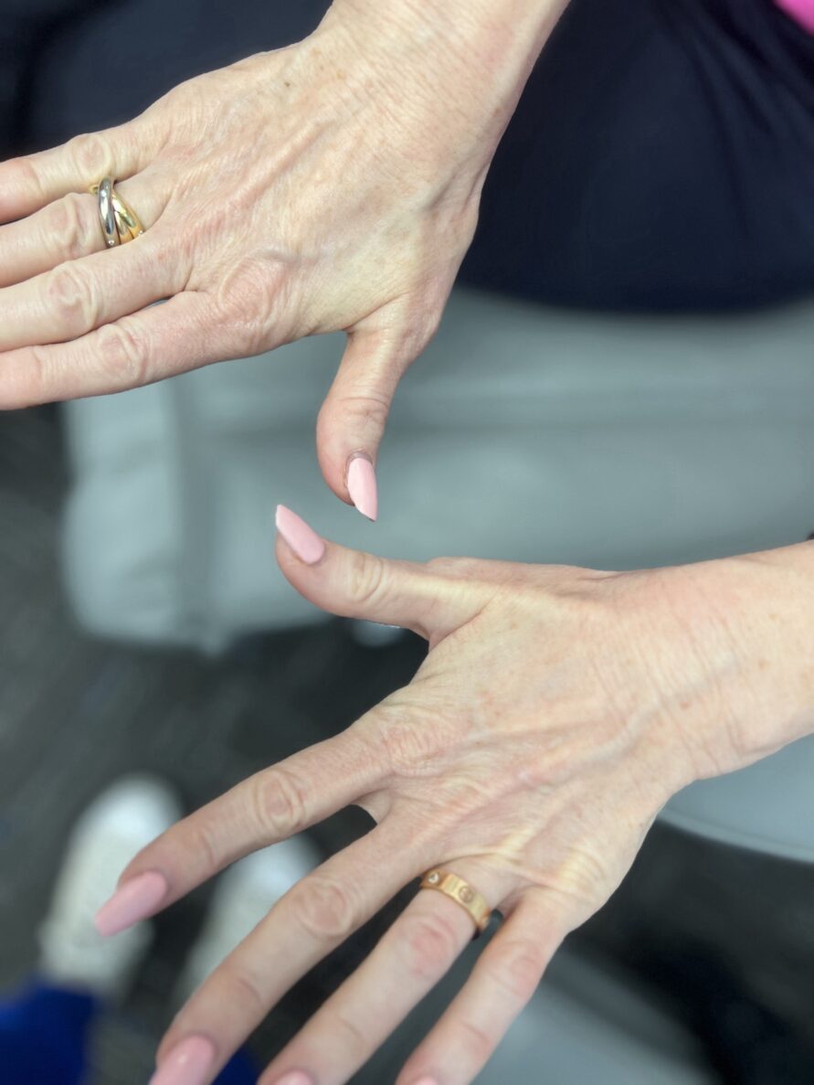 Radiesse Hands - Revive Medical Spa